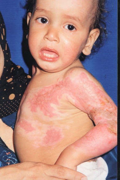 BSTTW World Wide Burned Children's Fund